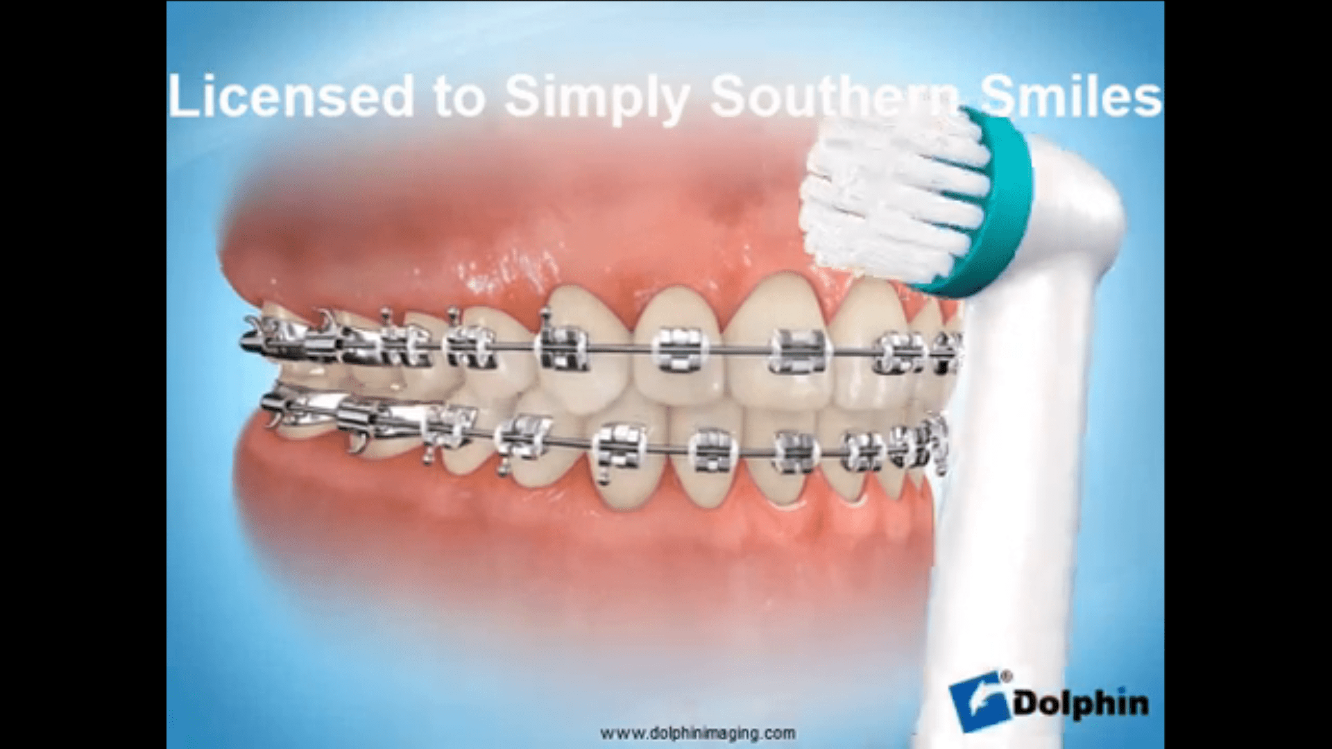 Not Brushing Teeth With Braces White Spots Natalie Yang Orthodontics